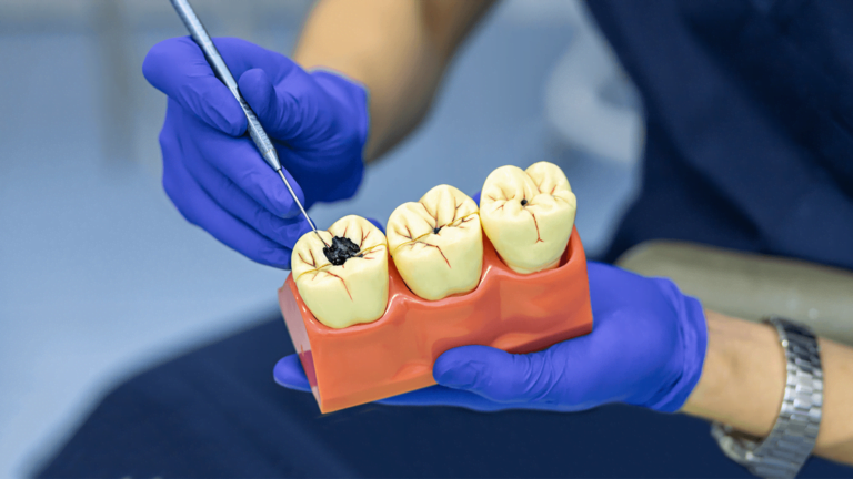 Cavities and Tooth Decay: Symptoms, Causes, and Treatments