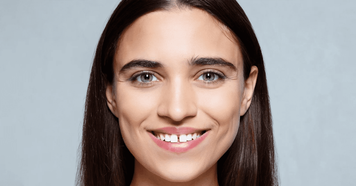 Ultimate Guide to Diastema Treatment: Fix Gaps in Your Teeth